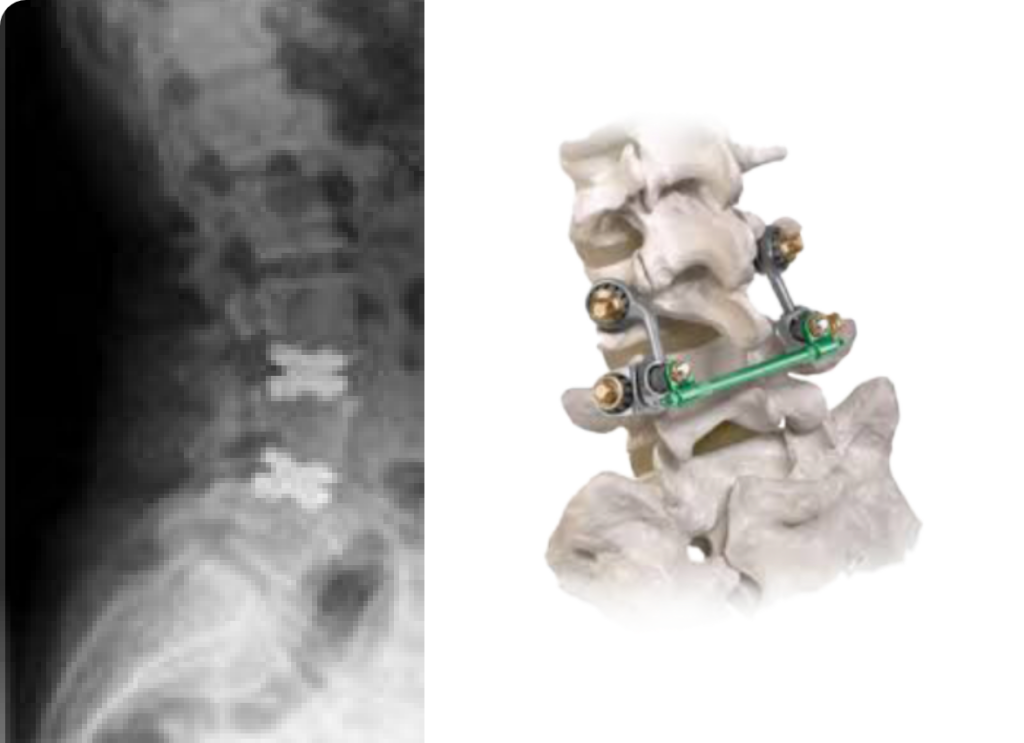 Lumbar - ONZ